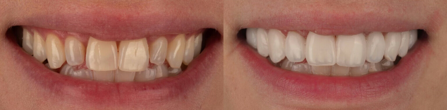 3D Printed Veneers Online Course & Follow-Along Kit - The MOD Institute