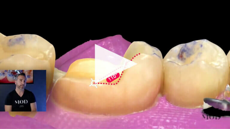 3D Printed Fillings Online Course & Follow-Along Kit - The MOD Institute