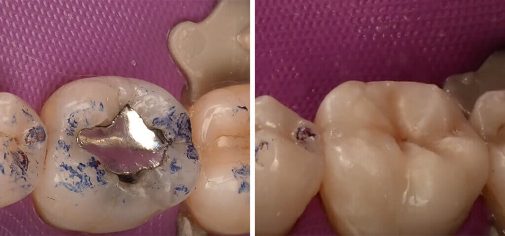 3D Printed Fillings Online Course & Follow-Along Kit - The MOD Institute