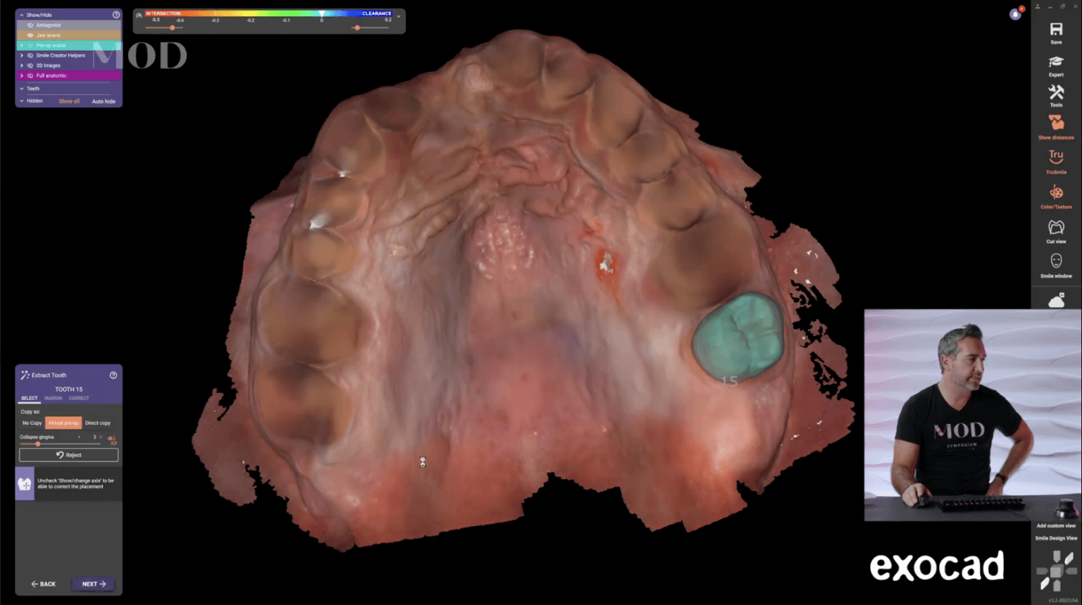 exocad Level 3: Denture Design - The MOD Institute