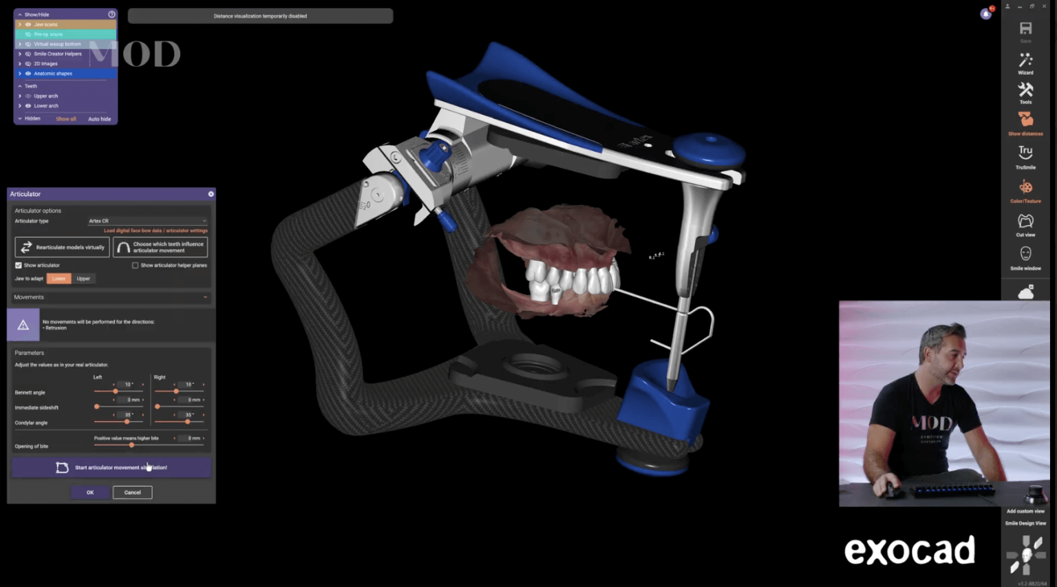 exocad Level 3: Denture Design - The MOD Institute