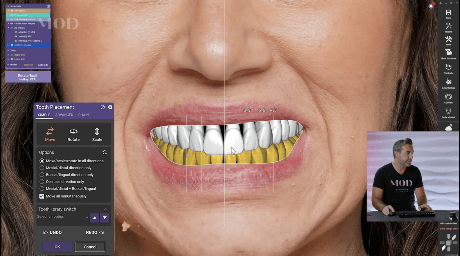 exocad Level 3: Denture Design - The MOD Institute