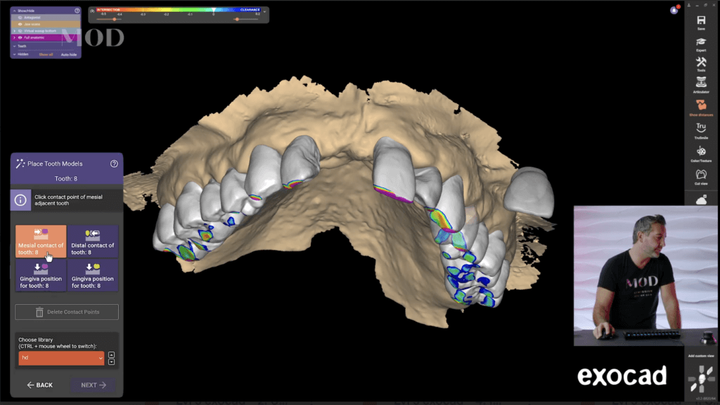 exocad Level 3: Denture Design - The MOD Institute