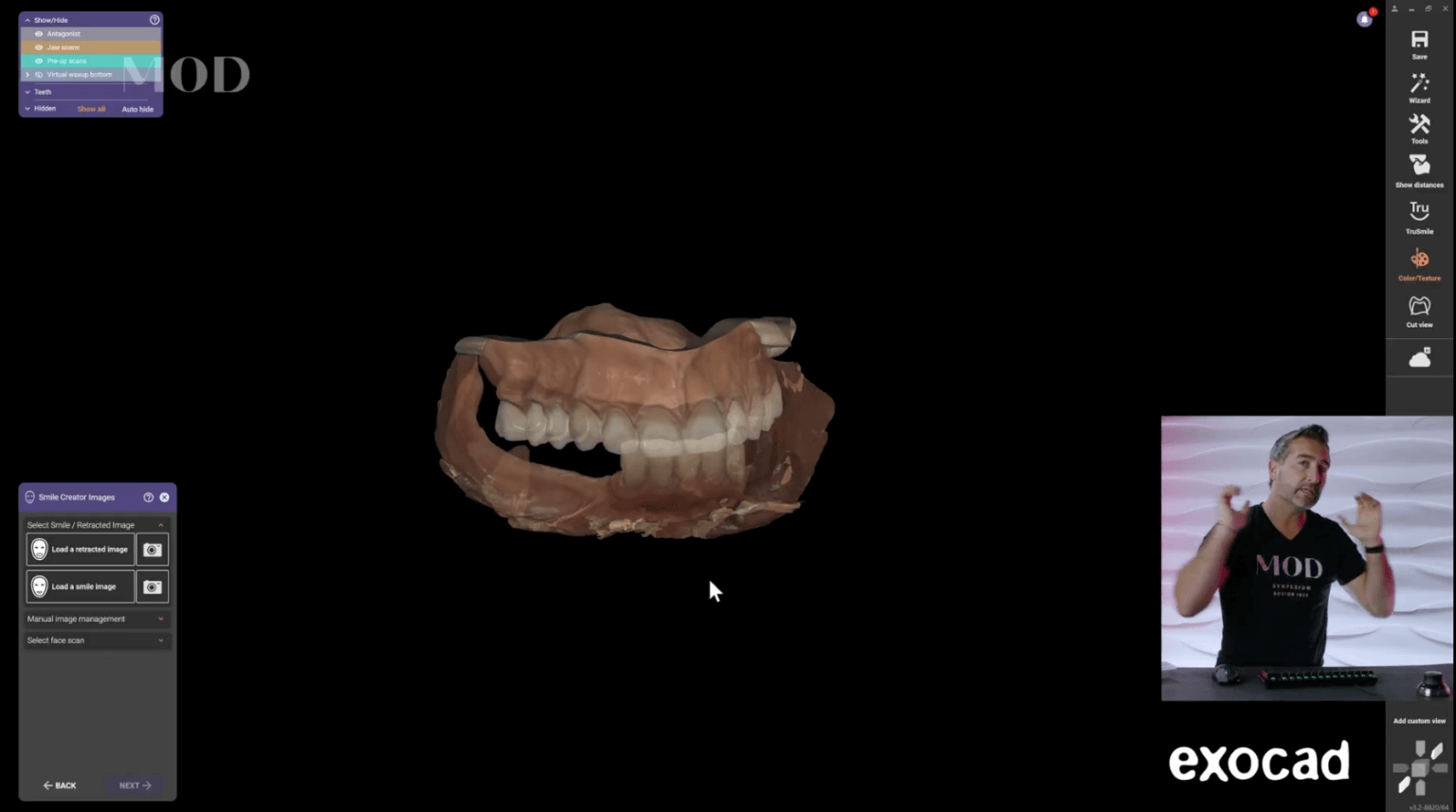 exocad Level 3: Denture Design - The MOD Institute