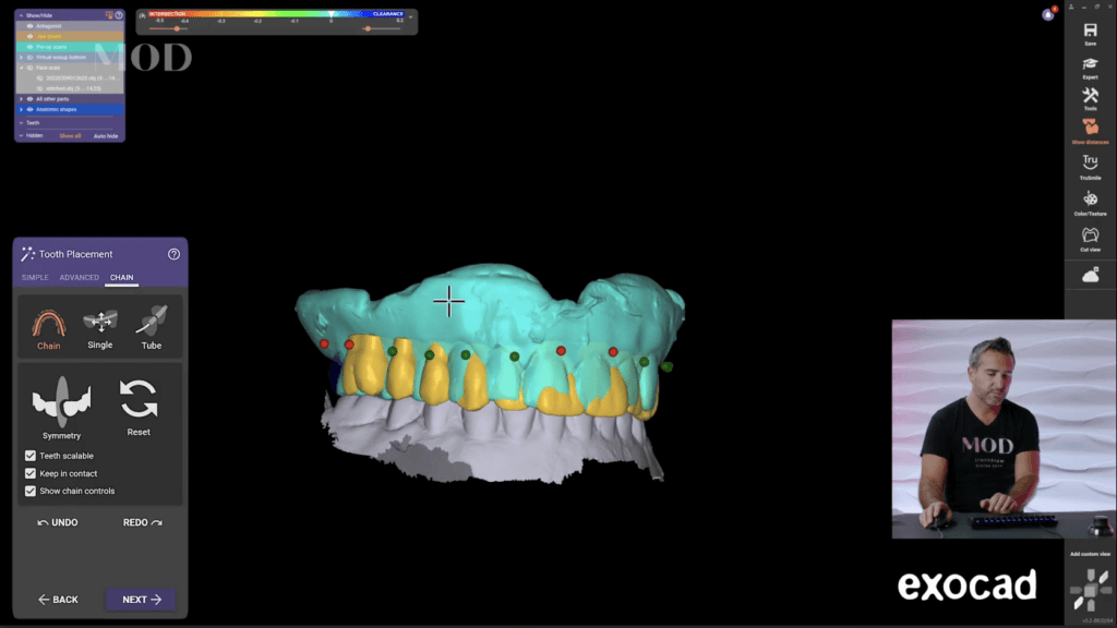 exocad Level 3: Denture Design - The MOD Institute