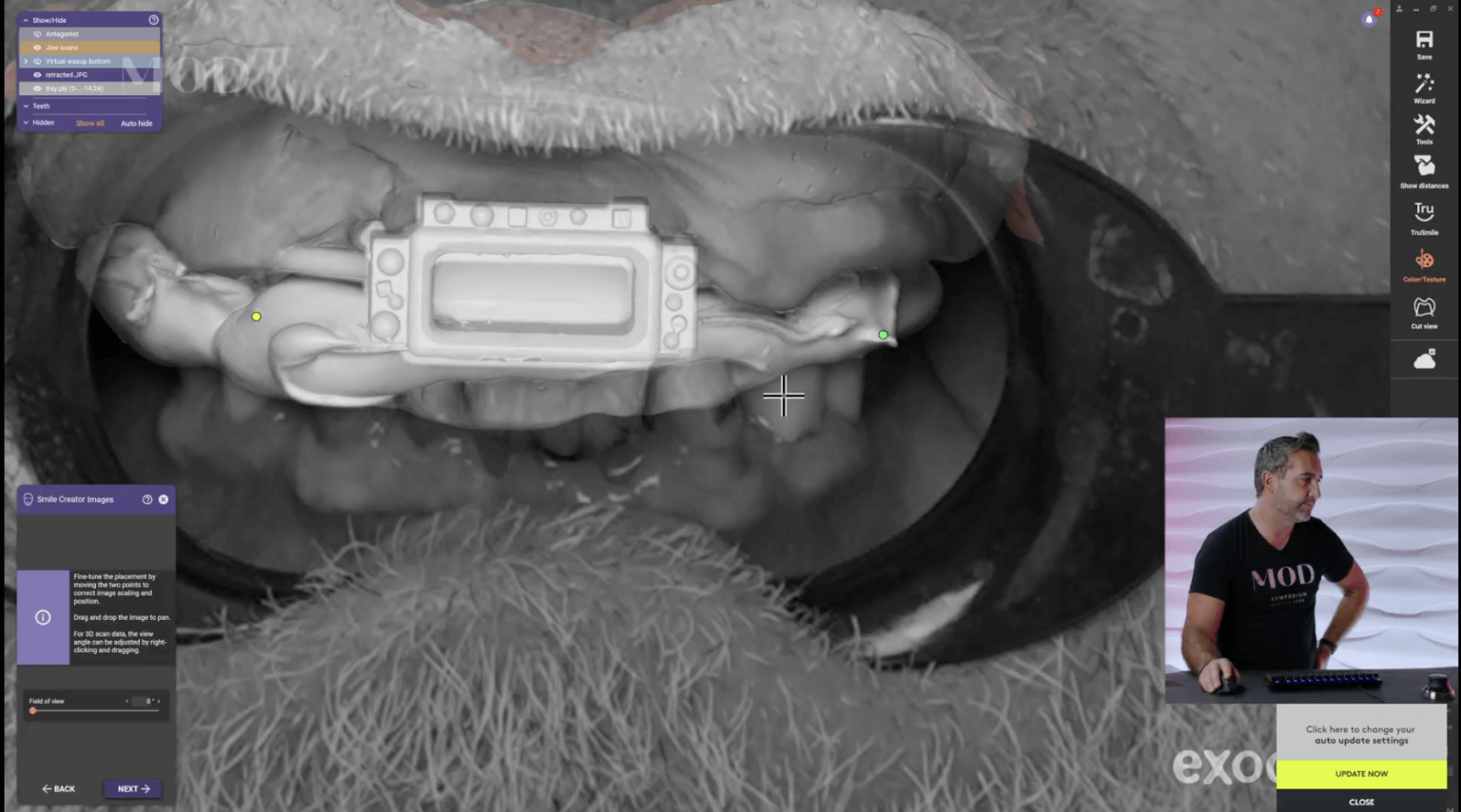 exocad Level 3: Denture Design - The MOD Institute